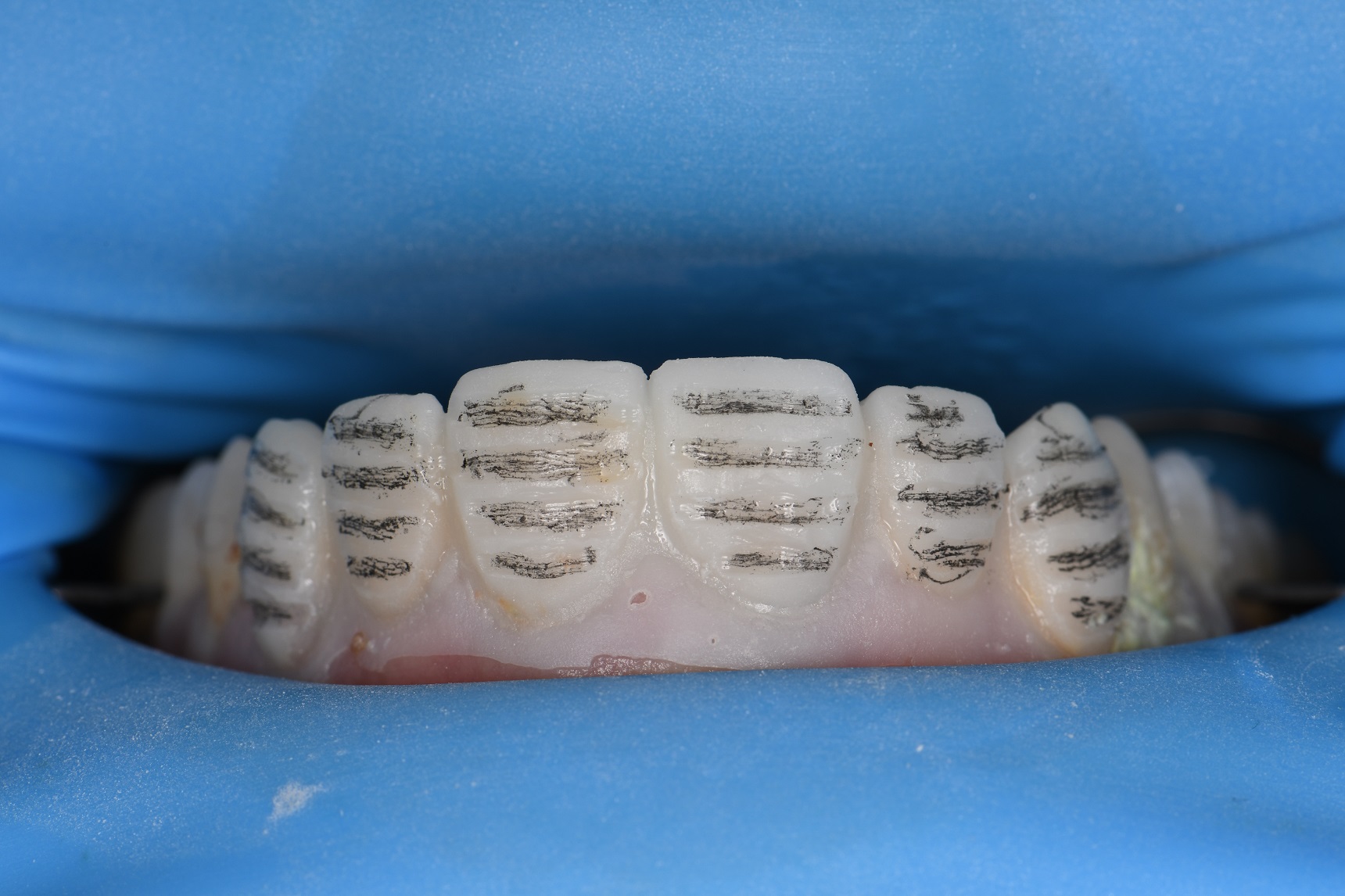 Veneer and Crown Preps using the APT Veneer and Crown Preps using the APT