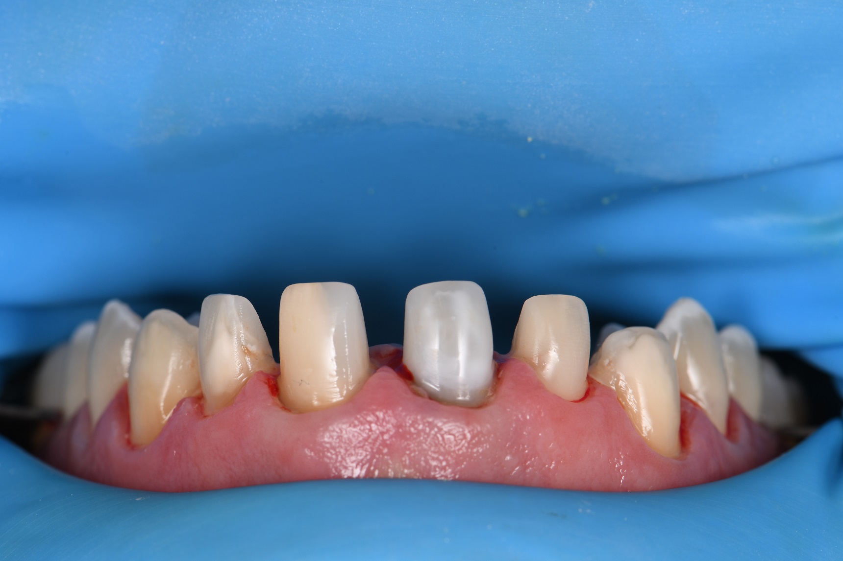 Smile Makeover | Porcelain Veneers Smile Makeover | Porcelain Veneers