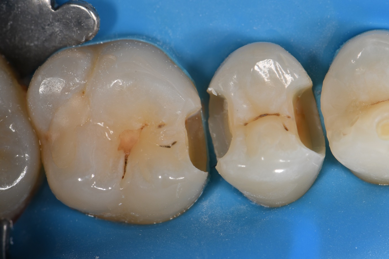 Dentsply Ceram.X Spectra ST Slot Machine