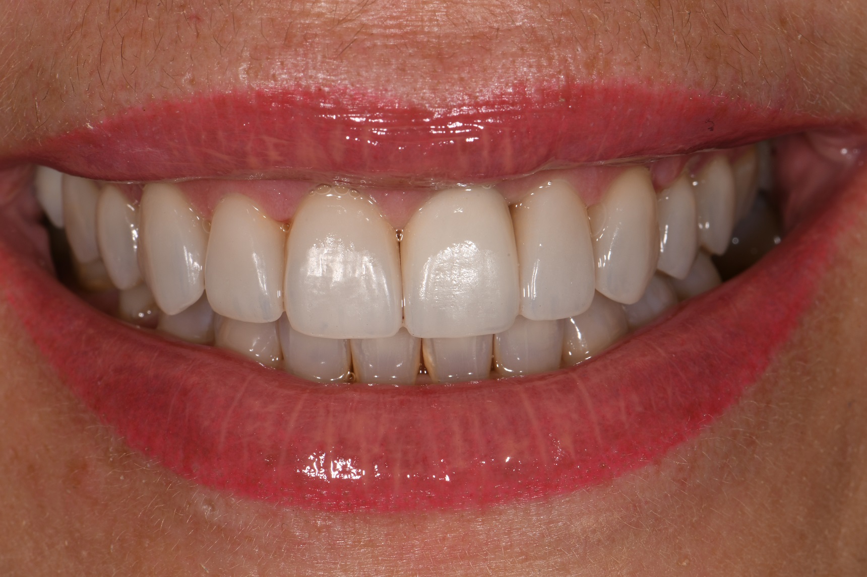 SureSmile | Smile Designer Pro | Veneers and Implant Crowns