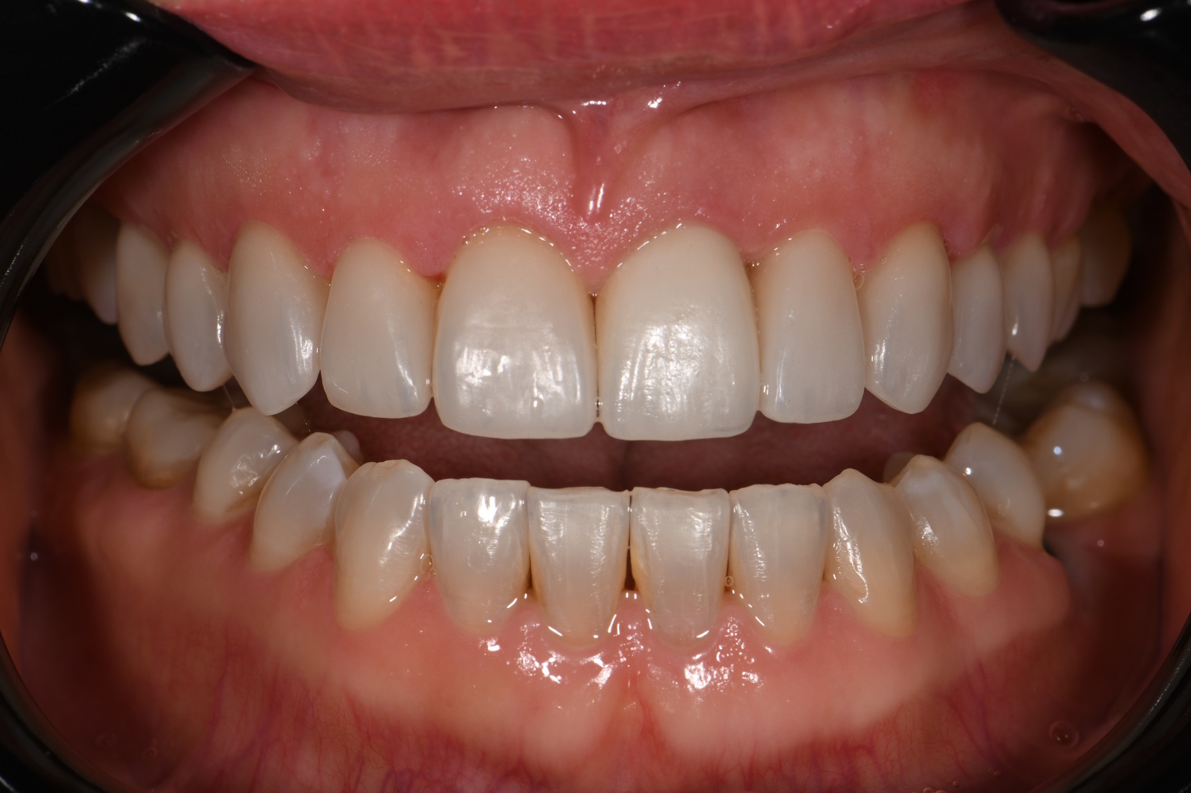 SureSmile | Smile Designer Pro | Veneers and Implant Crowns