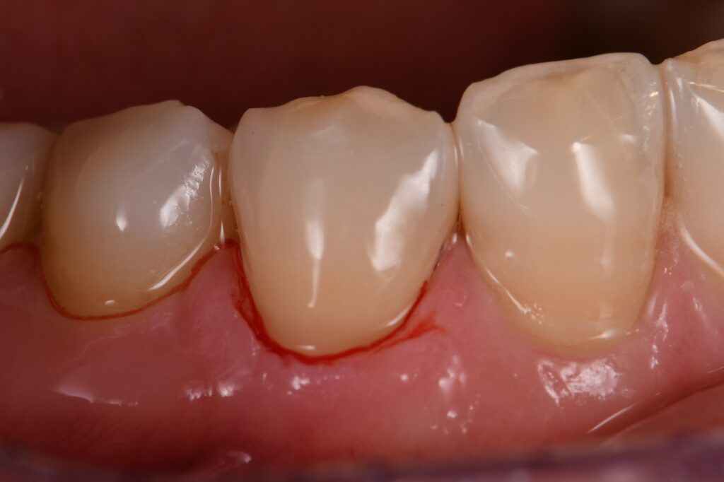 Class V difficult access