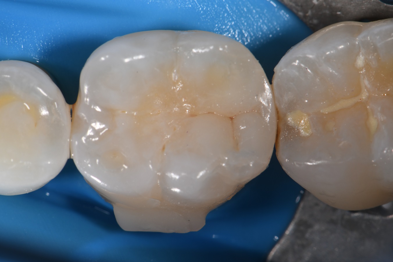 Replacement of old composite filling Replacement of old composite filling