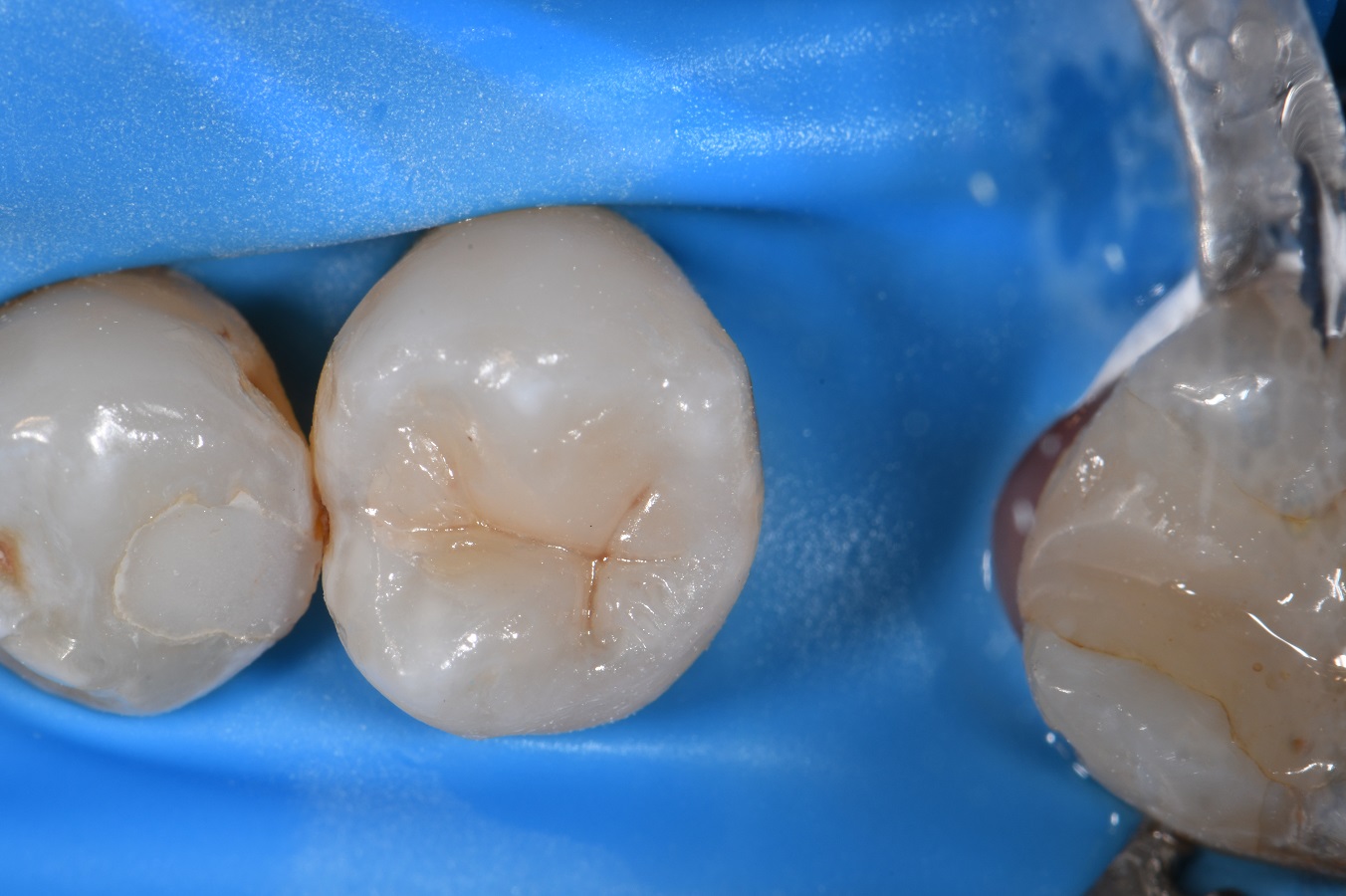 Making fillings invisible with bonded composite Making fillings ...