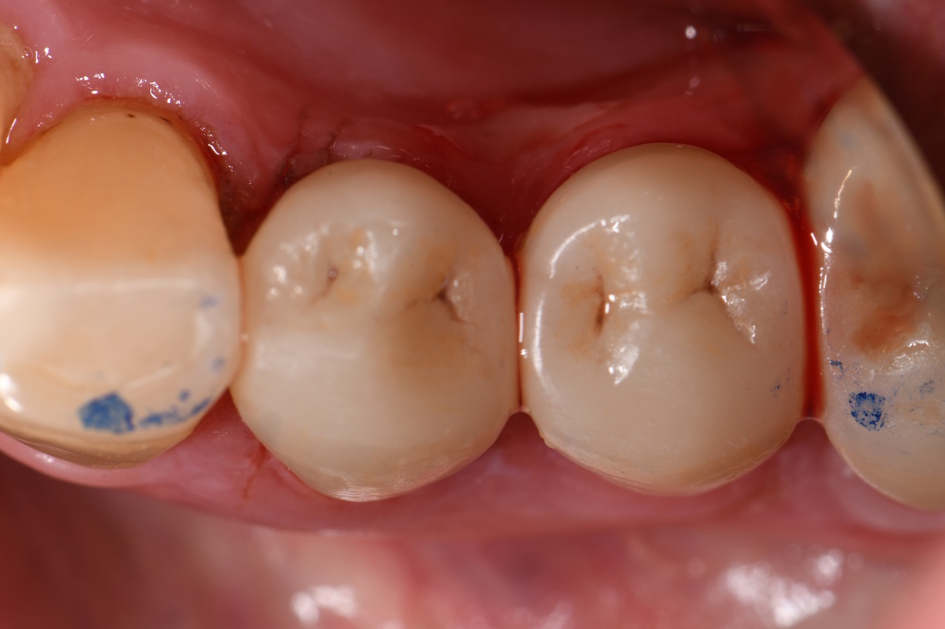 Crown Leakage with Replacement Required Crown Leakage with Replacement ...