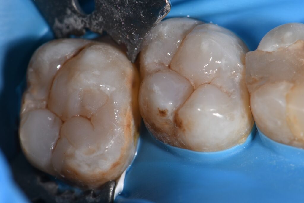 Cavities on Wisdom Teeth Restored Cavities on Wisdom Teeth Restored