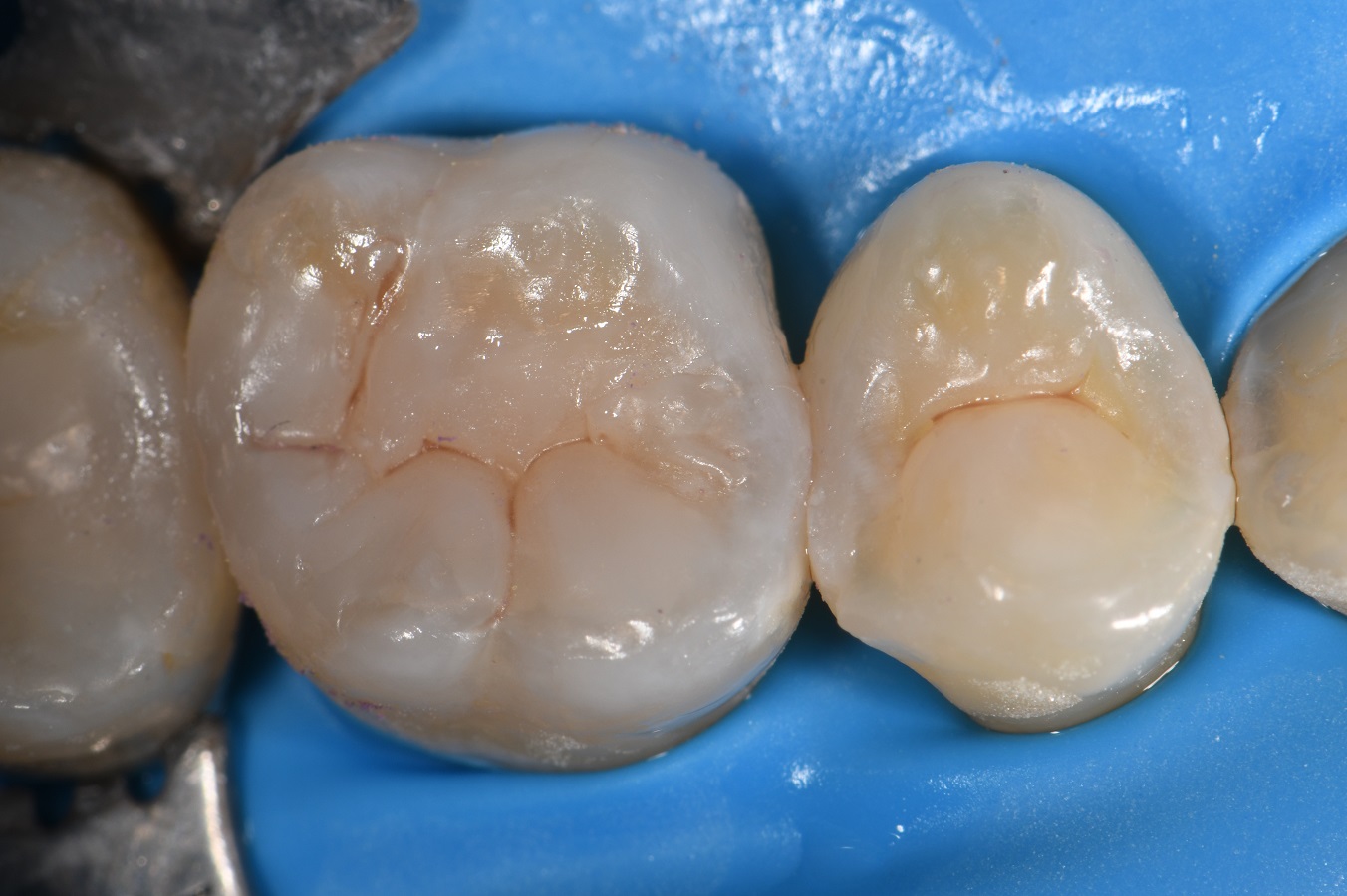 Dentin erosion insulation restoration Dentin erosion insulation restoration