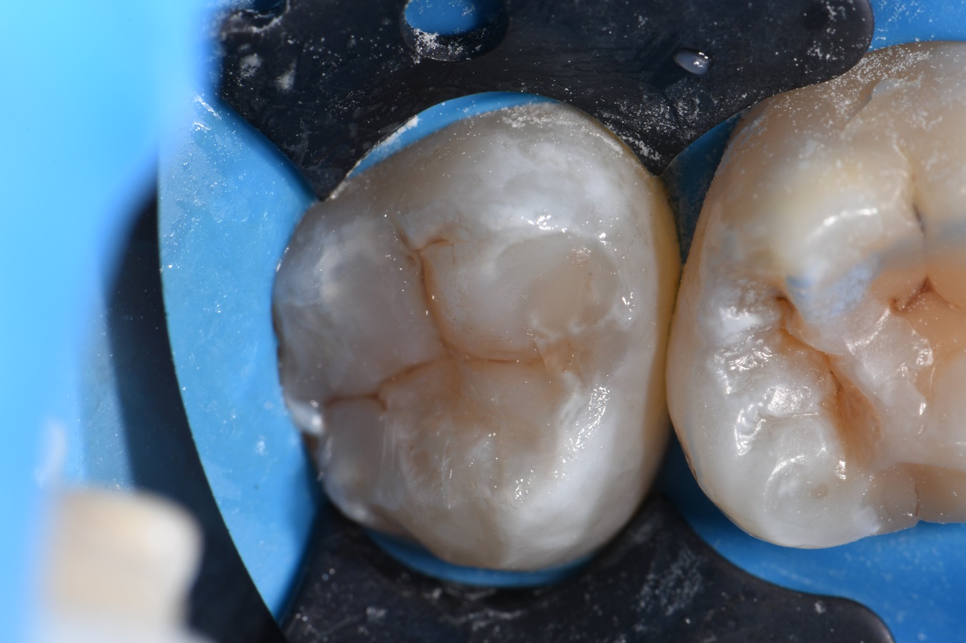 Hypomineralized Molar Composite Resin Restoration