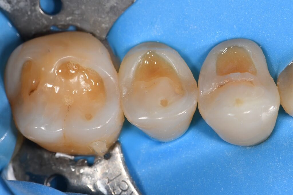 Erosion Lesions Restored Erosion Lesions Restored