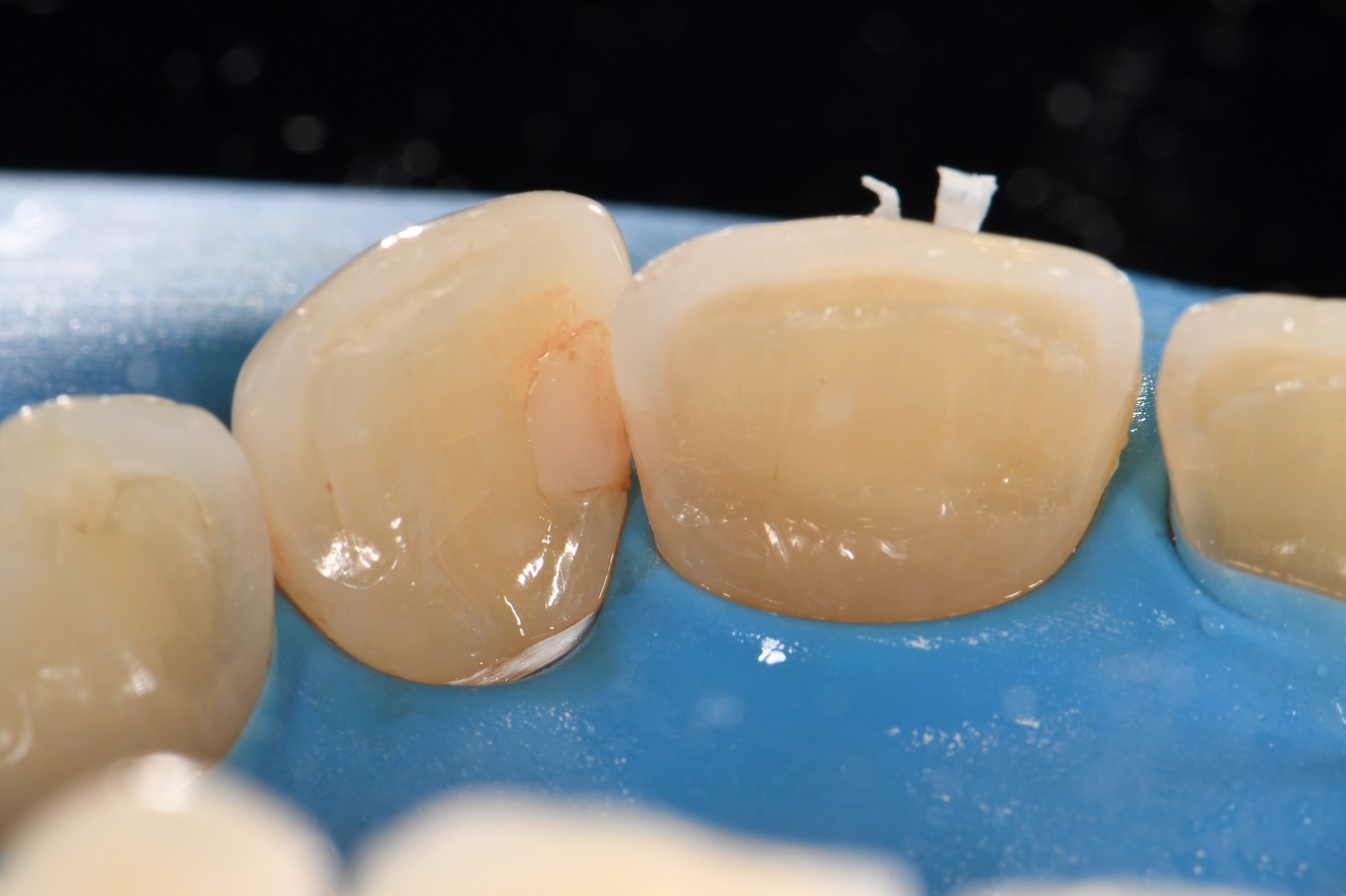 Class III composite restorations Class III composite restorations