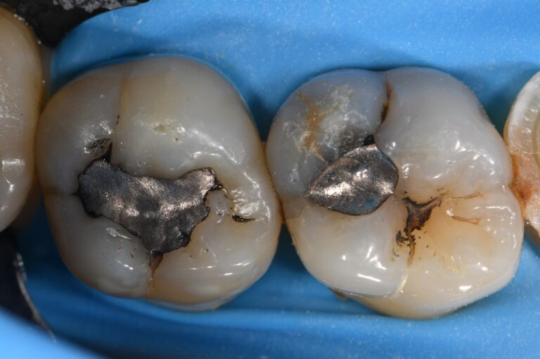 Removing Cracks and Amalgam in Teeth Removing Cracks and Amalgam in Teeth