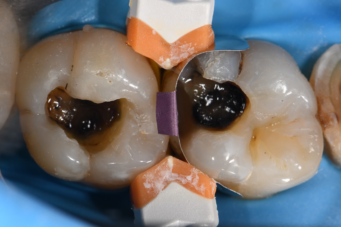 Removing Cracks and Amalgam in Teeth Removing Cracks and Amalgam in Teeth