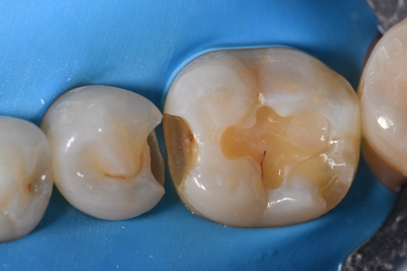 Invisible Posterior Composite Restorations