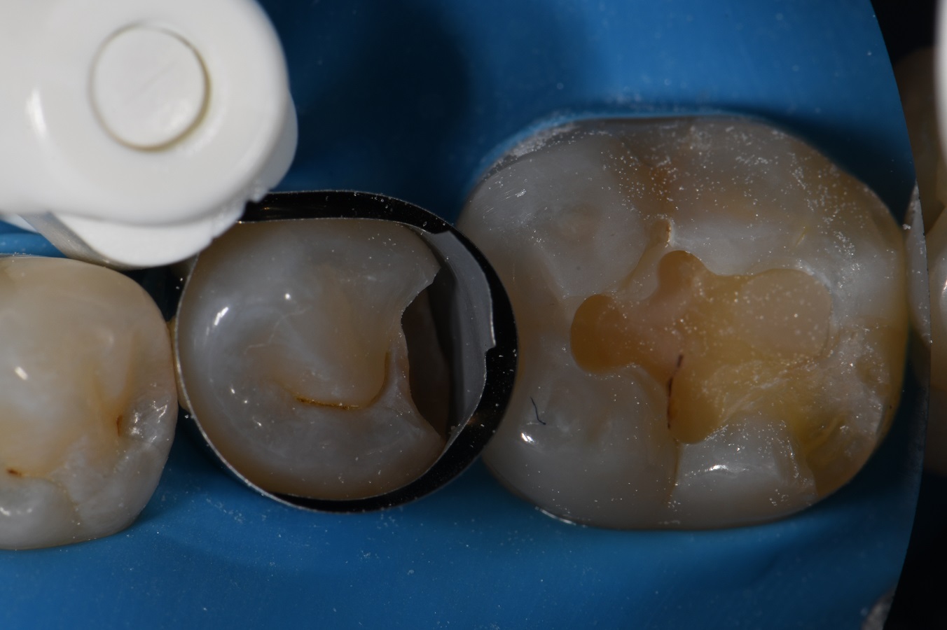 Invisible Posterior Composite Restorations