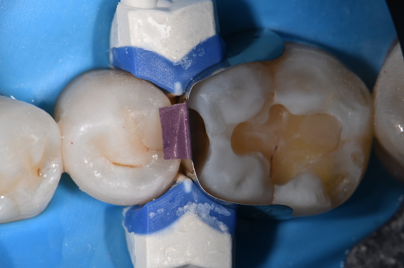 Invisible Posterior Composite Restorations