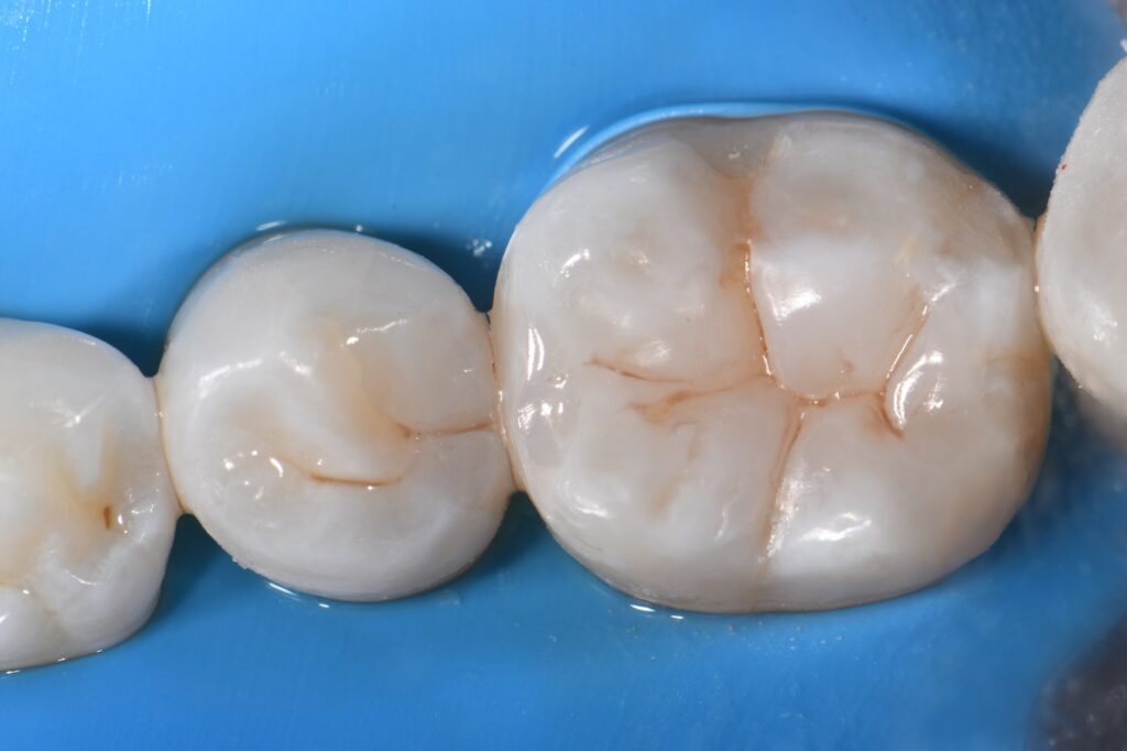Invisible Posterior Composite Restorations