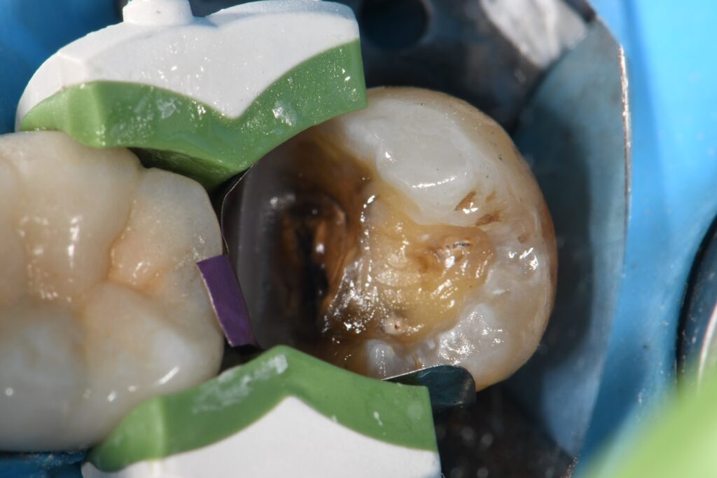 Garrison Dental Wide Prep Ring Garrison Dental Wide Prep Ring