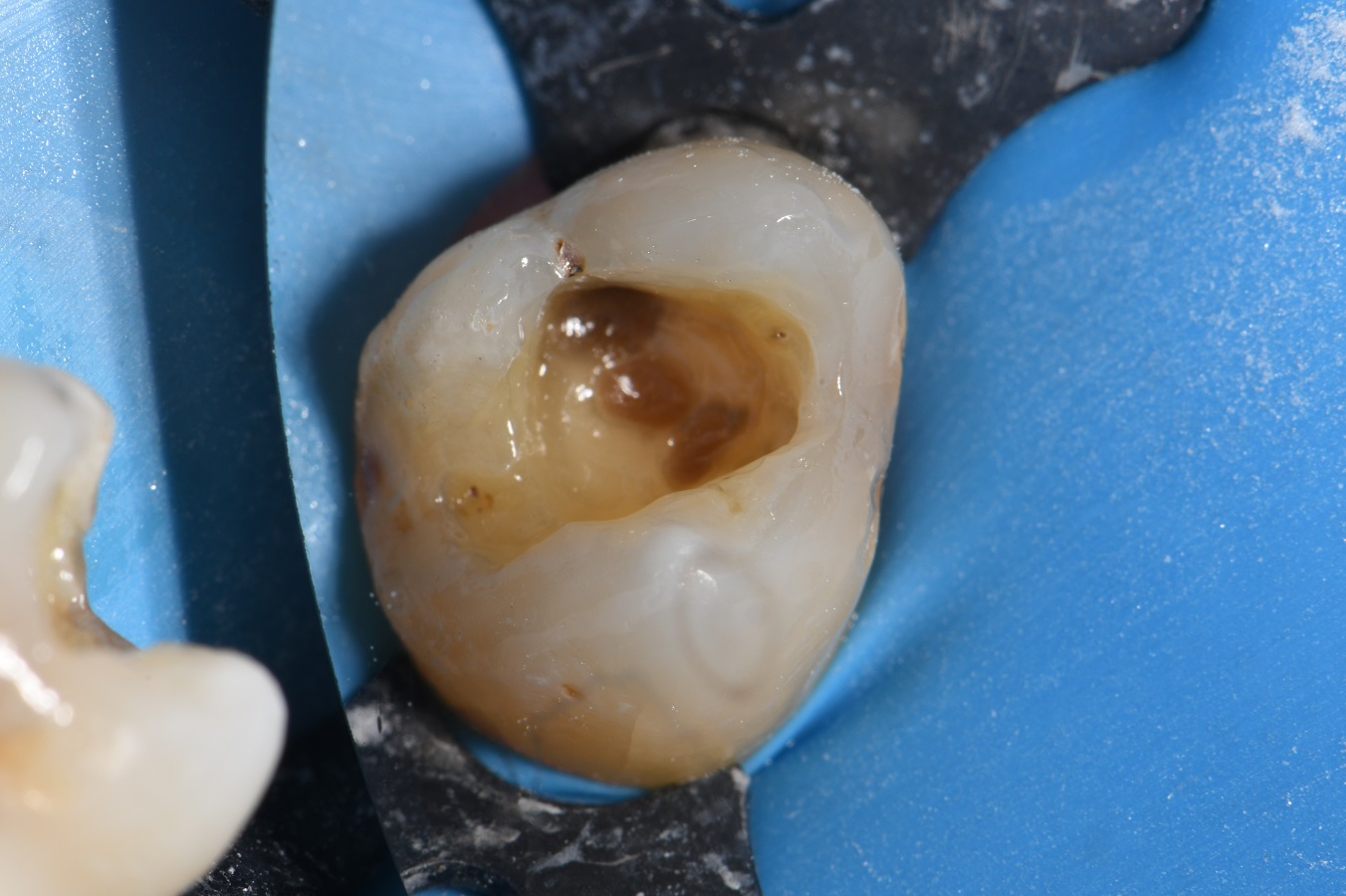 Restoration of a wisdom tooth in function Restoration of a wisdom tooth ...