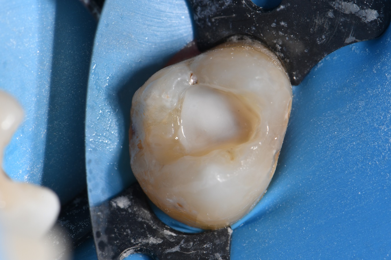 Restoration of a wisdom tooth in function Restoration of a wisdom tooth ...