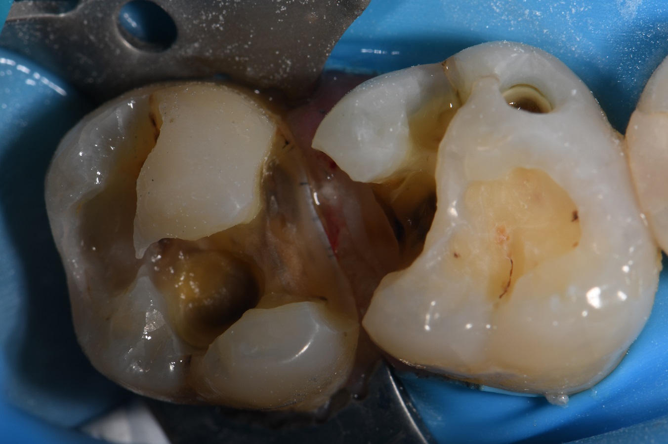Dental Amalgam Replacements with Composite