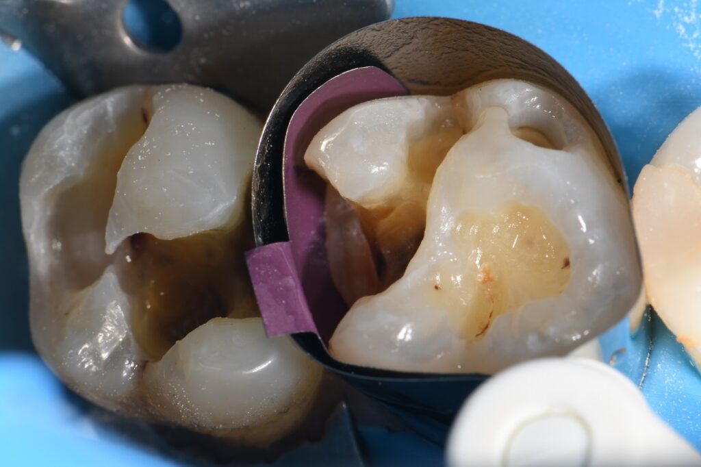 Dental Amalgam Replacements with Composite
