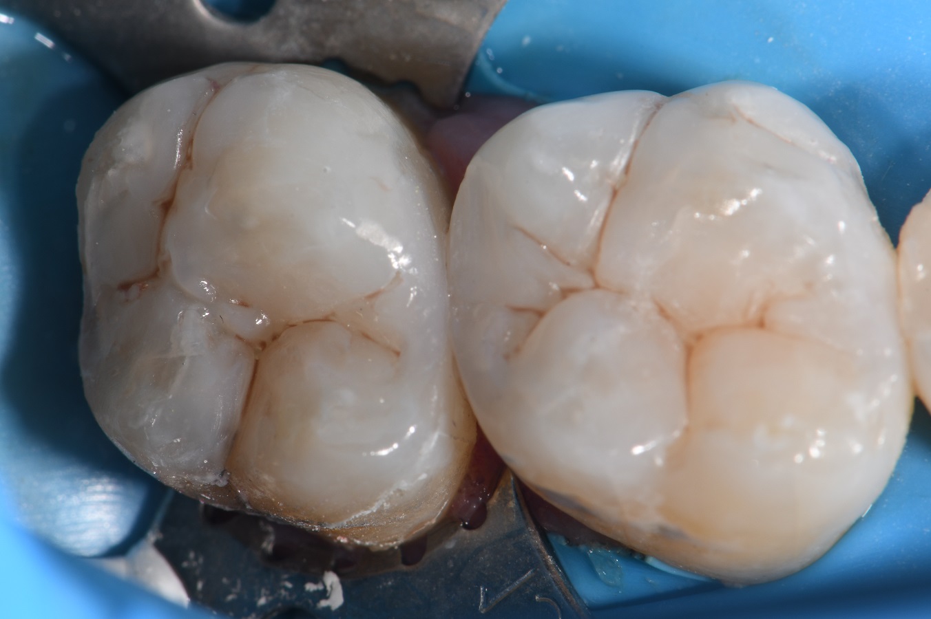 Dental Amalgam Replacements with Composite