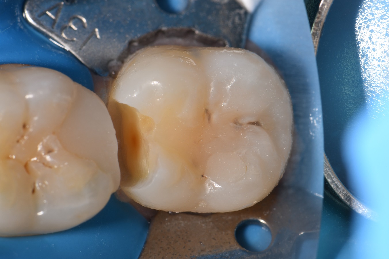 Composite Slot Restoration Composite Slot Restoration