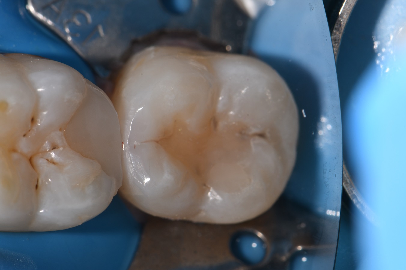 Composite Slot Restoration Composite Slot Restoration