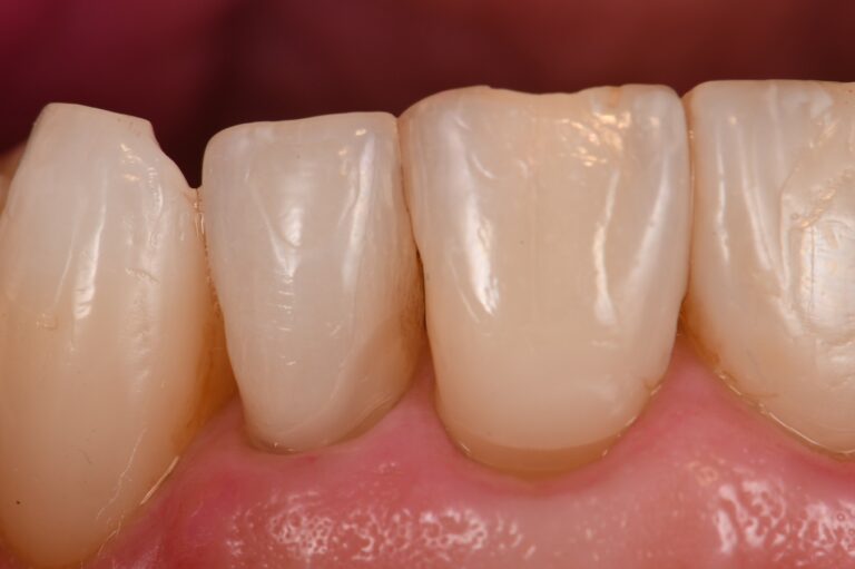 Subgingival cervical abrasion Subgingival cervical abrasion