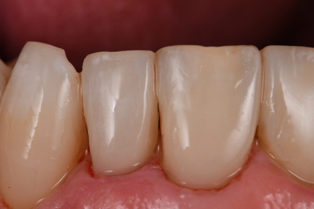 Subgingival cervical abrasion Subgingival cervical abrasion