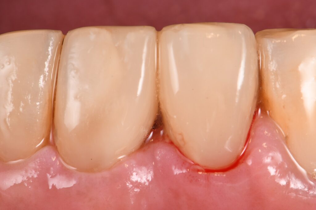 Diastema Closure with Composite Resin Diastema Closure with Composite Resin