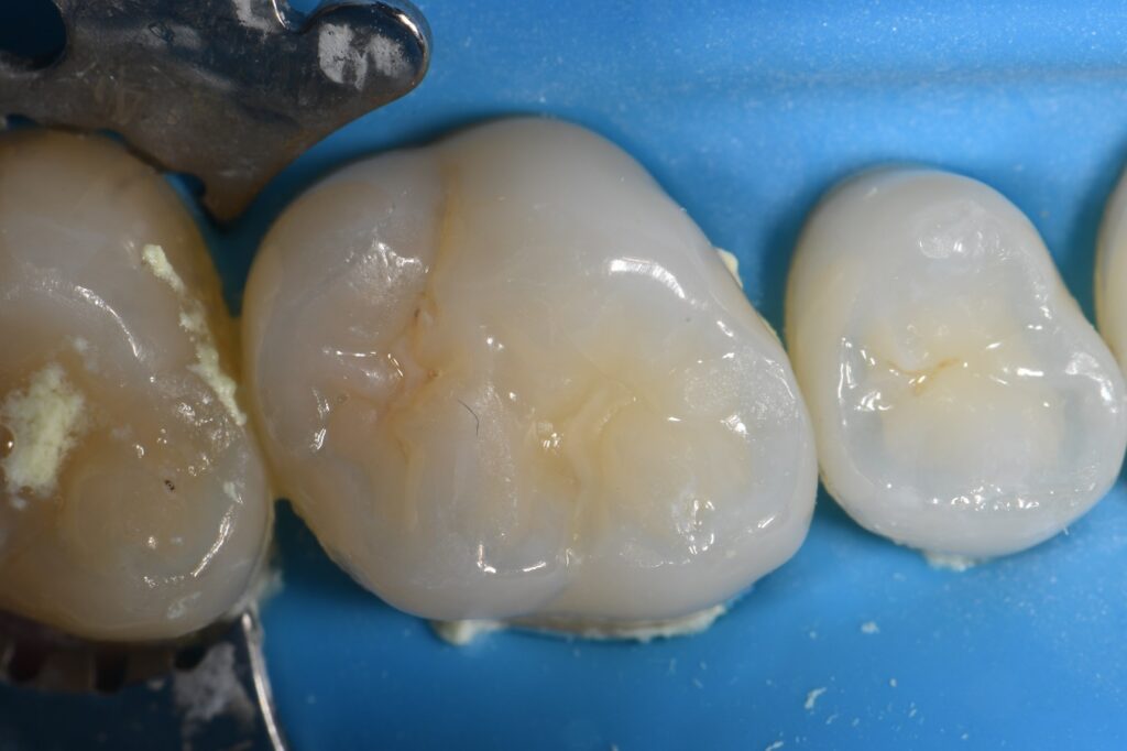 Invisible Slot Restoration Invisible Slot Restoration