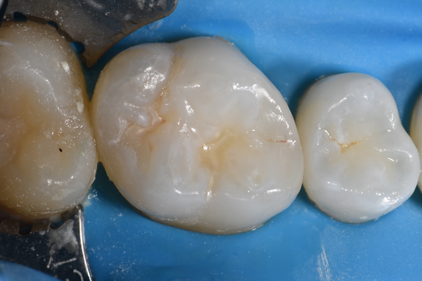 Invisible Slot Restoration Invisible Slot Restoration