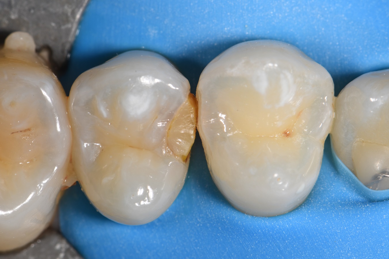 Slot restorations back to back Slot restorations back to back