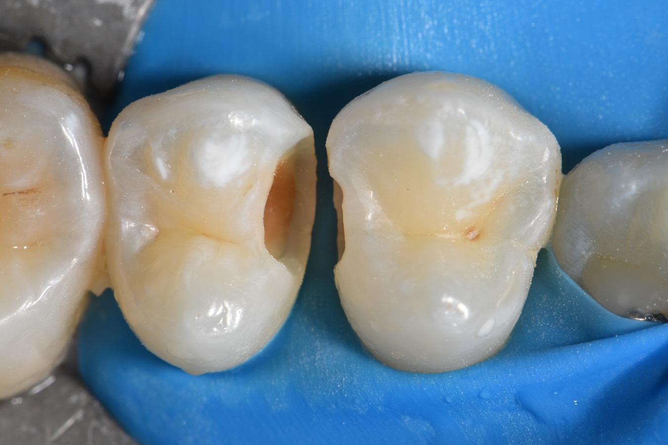 Slot restorations back to back Slot restorations back to back