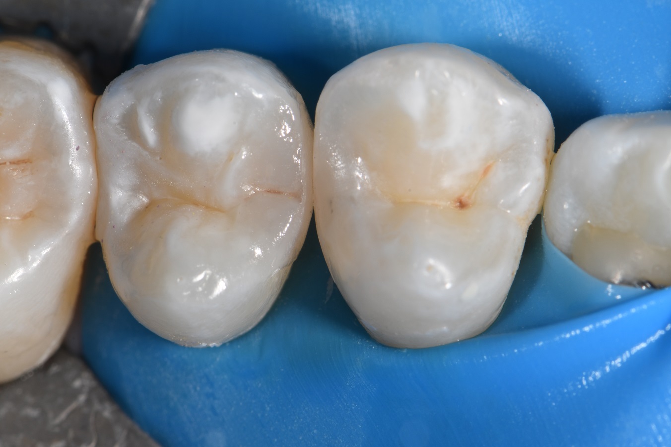 Slot restorations back to back Slot restorations back to back