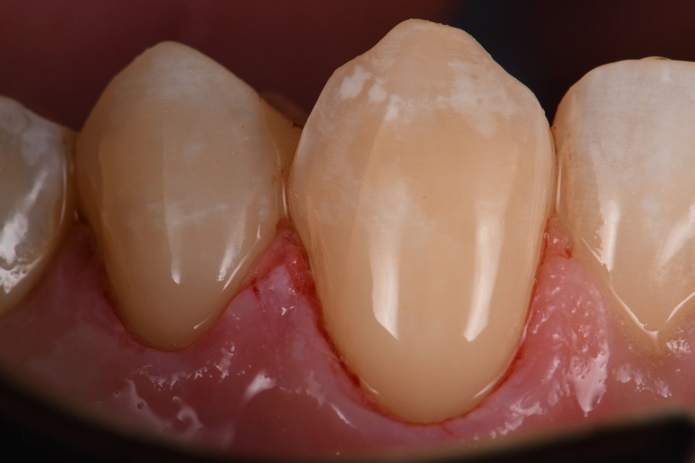 Cervical Abrasion Root Sensitivity Cervical Abrasion Root Sensitivity