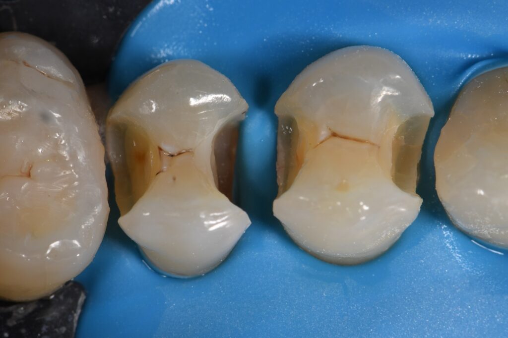 Bicuspid reconstruction in composite resin Bicuspid reconstruction in ...