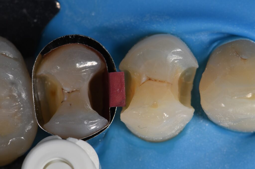 Bicuspid reconstruction in composite resin Bicuspid reconstruction in ...