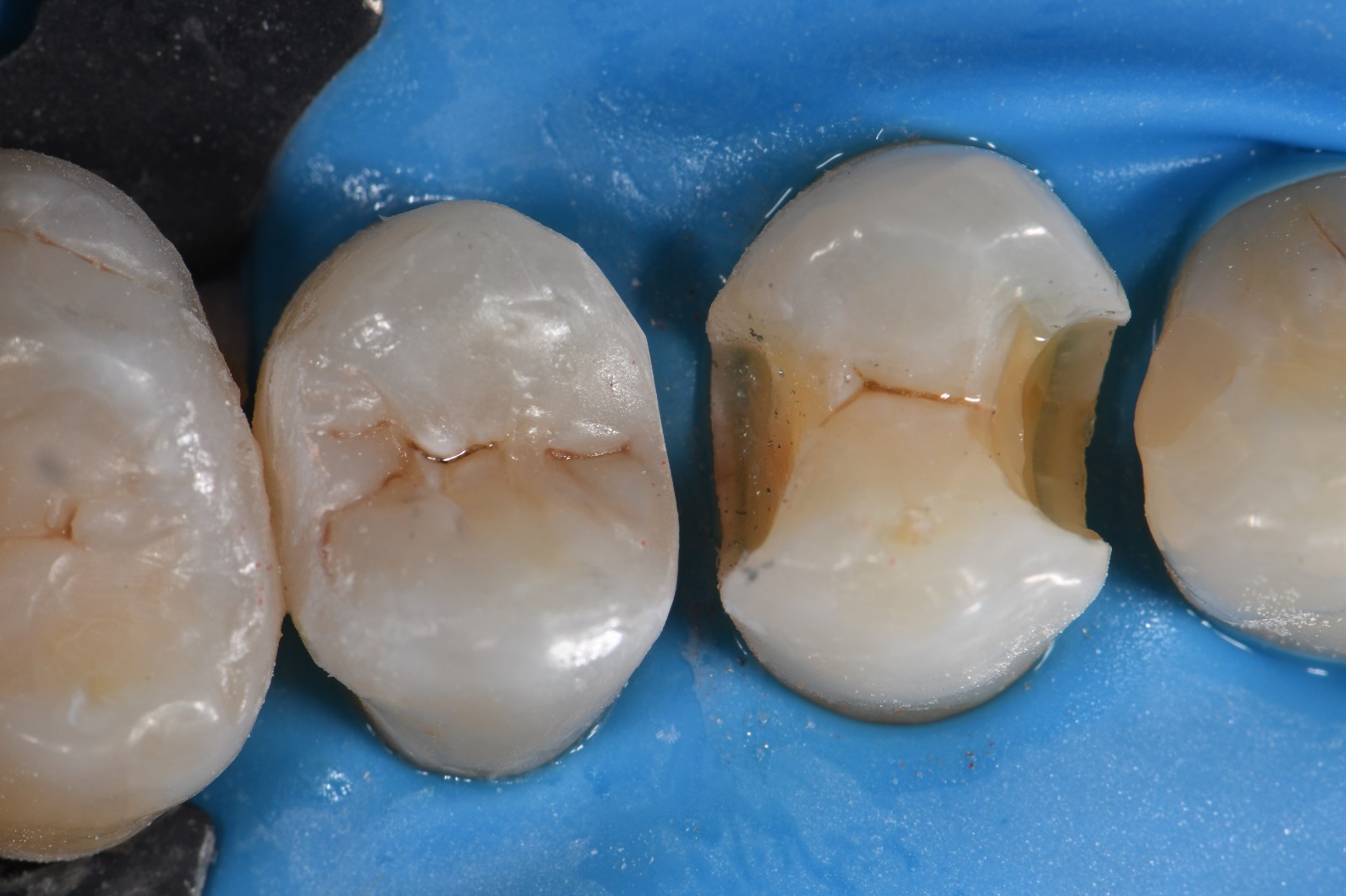 Bicuspid reconstruction in composite resin Bicuspid reconstruction in ...