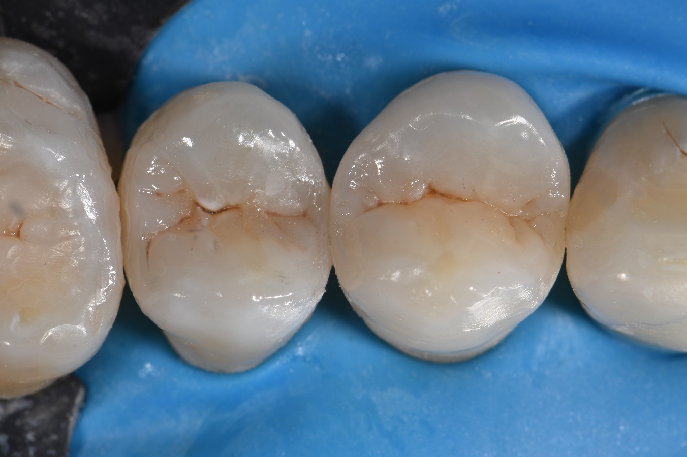 Bicuspid reconstruction in composite resin Bicuspid reconstruction in ...