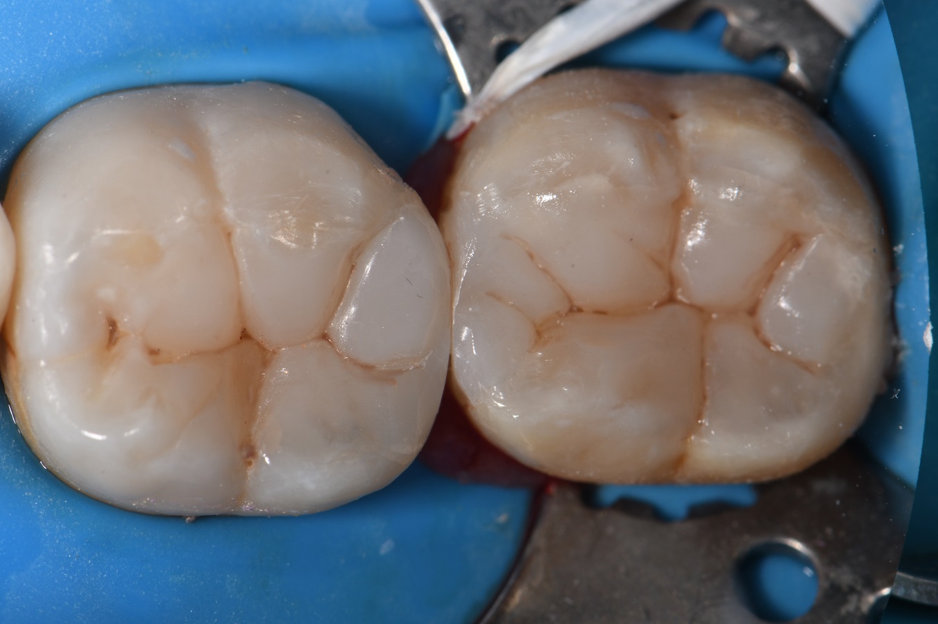 Partial Restoration Replacement