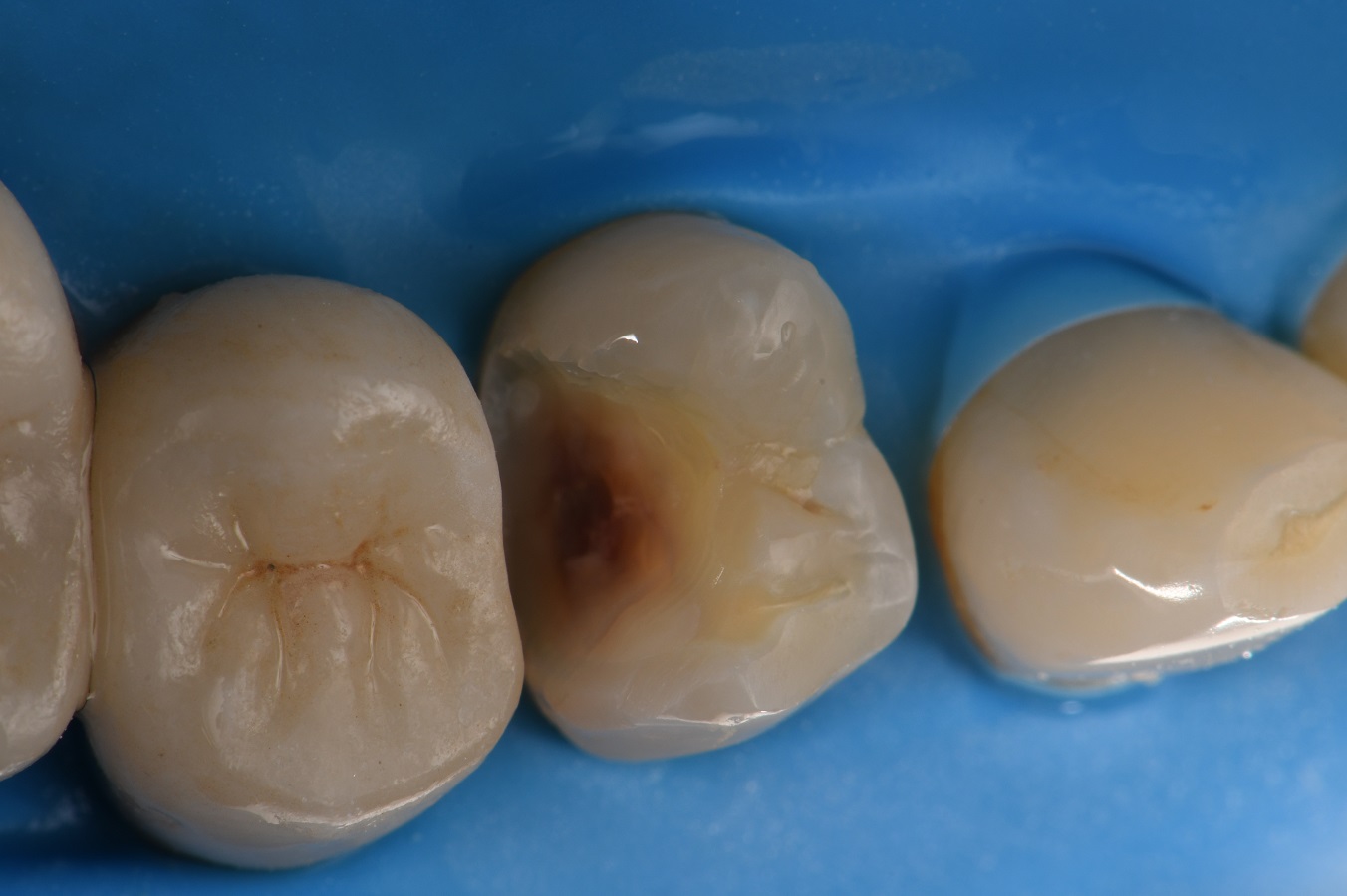 Garrison and Kerr Simplishade Class II Garrison and Kerr Simplishade ...