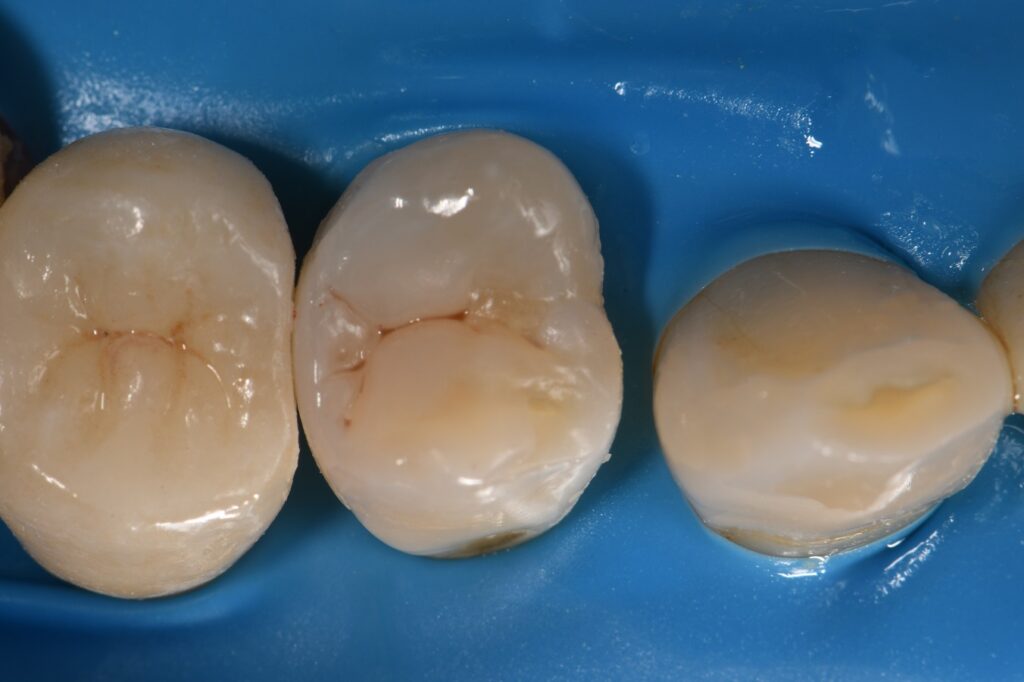 Garrison and Kerr Simplishade Class II Garrison and Kerr Simplishade ...