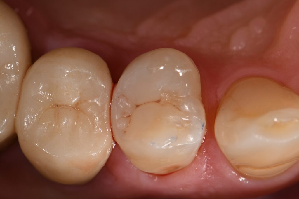 Garrison and Kerr Simplishade Class II Garrison and Kerr Simplishade ...