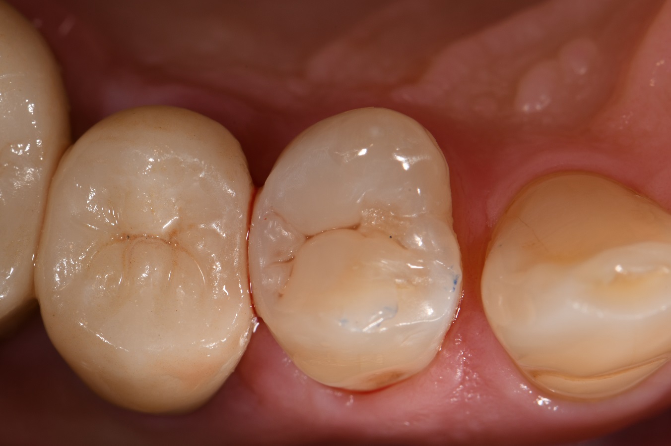 Garrison and Kerr Simplishade Class II Garrison and Kerr Simplishade ...