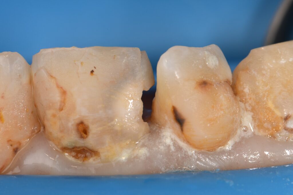 Rampant Caries Breakdown Restored with Composite Resin