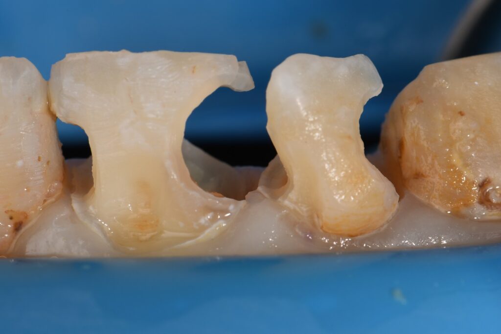 Rampant Caries Breakdown Restored with Composite Resin