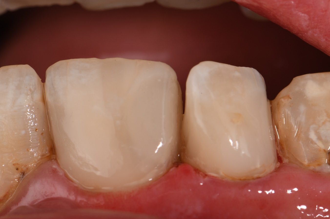 Rampant Caries Breakdown Restored with Composite Resin