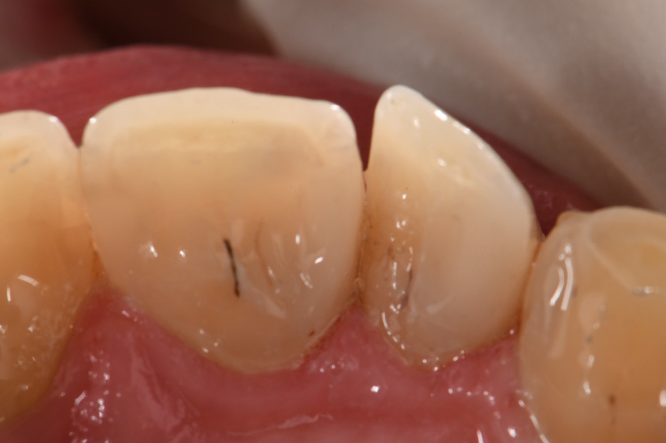 Rampant Caries Breakdown Restored with Composite Resin